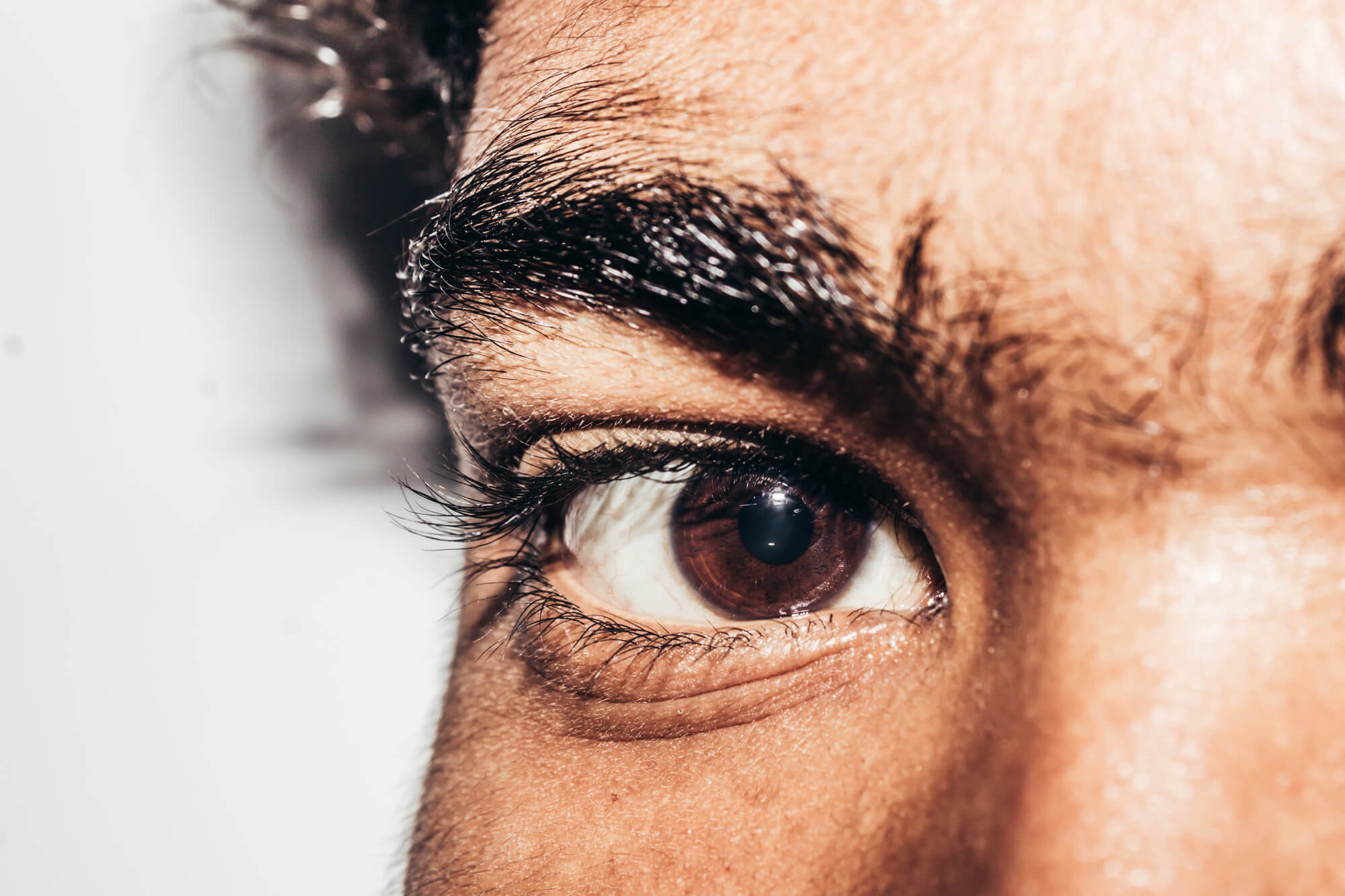 Retinal Migraine: What Is It?